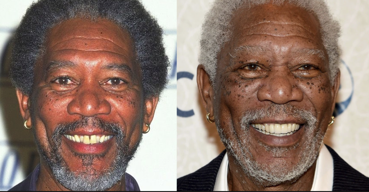 17 Celebs Before and After Veneers | eBaum's World