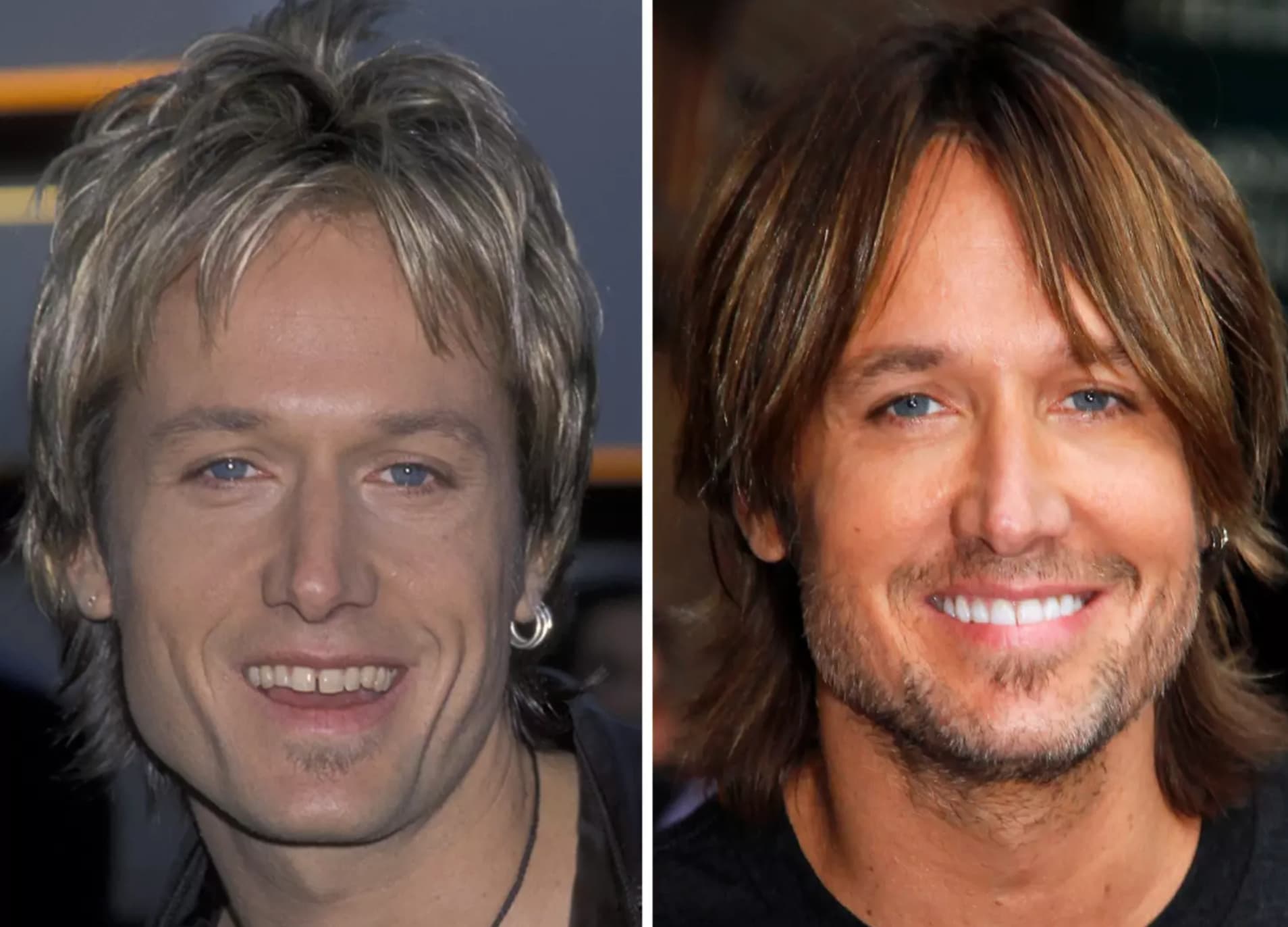17 Celebs Before and After Veneers | eBaum's World