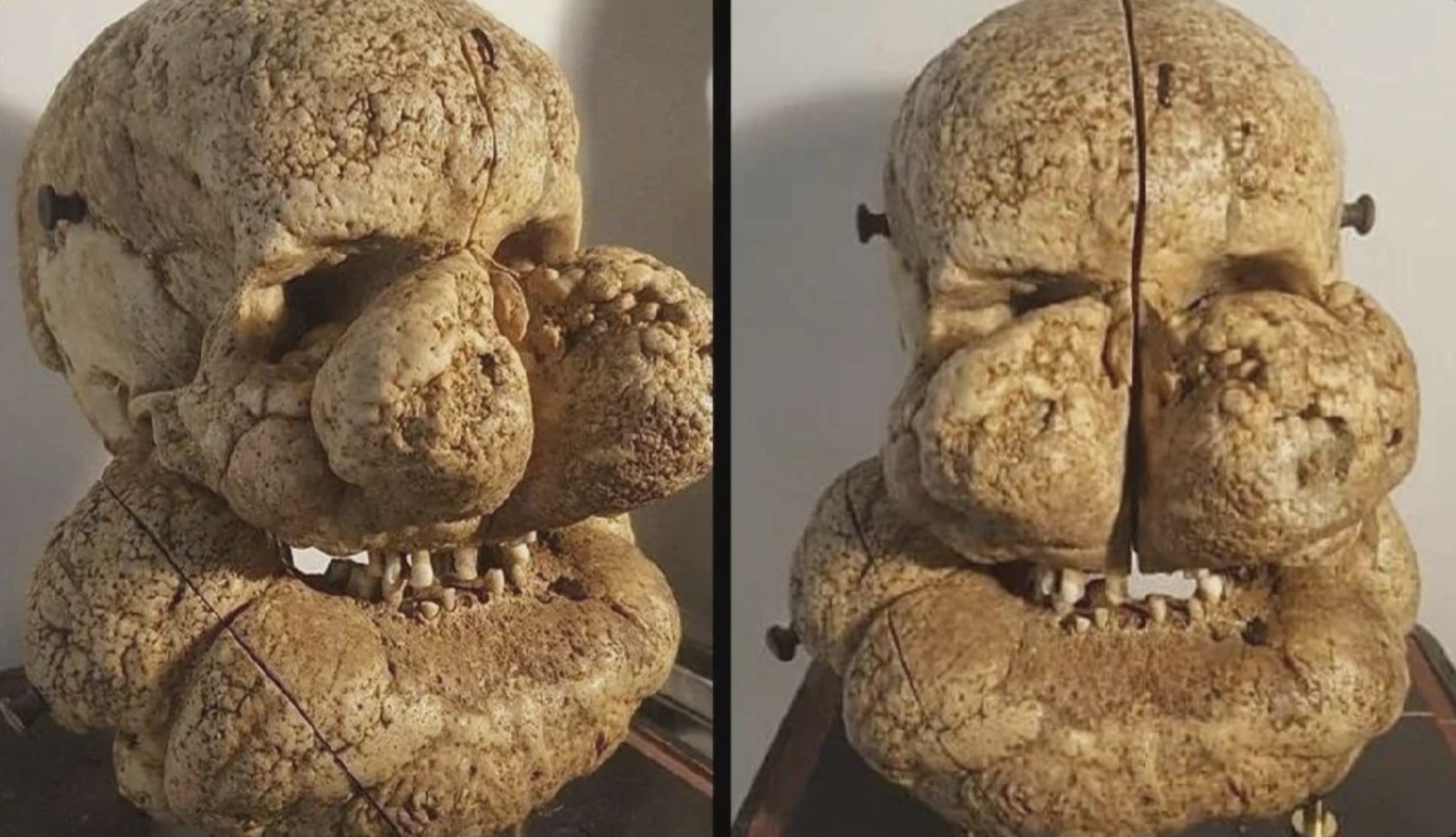 15 Syndromes You Don't Want to Google (WARNING: GRAPHIC) | eBaum's World