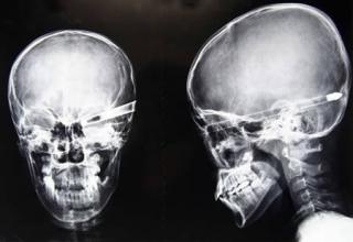 21 Real Crazy X-Rays - Ouch Gallery | eBaum's World
