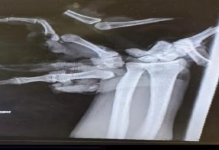 14 X-Rays of Hands the Day After the Fourth of July - Wtf Gallery ...