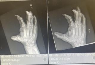 14 X-Rays of Hands the Day After the Fourth of July - Wtf Gallery ...