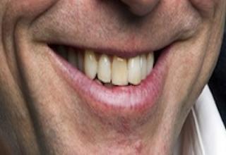 Which famous celeb do these horrible teeth belong to? - Eww Gallery ...