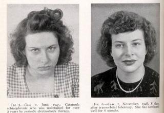 20 Old Photos Showing People Before And After Lobotomies - Creepy ...