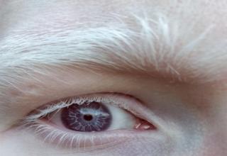 18 Genetic Anomalies That are Rare and Unique - Wow Gallery | eBaum's World