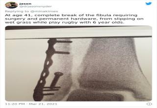 24 Stupid Injuries People Wish They Had Avoided - Funny Gallery | eBaum ...