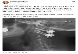 24 Stupid Injuries People Wish They Had Avoided - Funny Gallery | eBaum ...