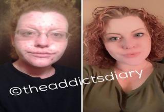 43 Before And After Transformations Of Drug Addicts - Ftw Gallery ...