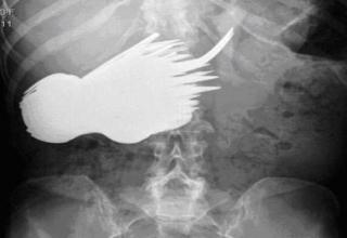 21 Real Crazy X-Rays - Ouch Gallery | eBaum's World